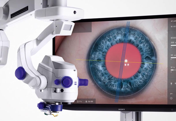 Artevo 800: mais precisão e segurança na cirurgia ocular - Ícone da ...
